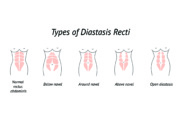 Learn More About Diastasis Recti – Abdominal Muscle Separation During ...