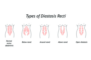 Learn More About Diastasis Recti – Abdominal Muscle Separation During ...