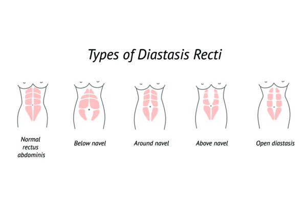 Learn More About Diastasis Recti – Abdominal Muscle Separation During ...